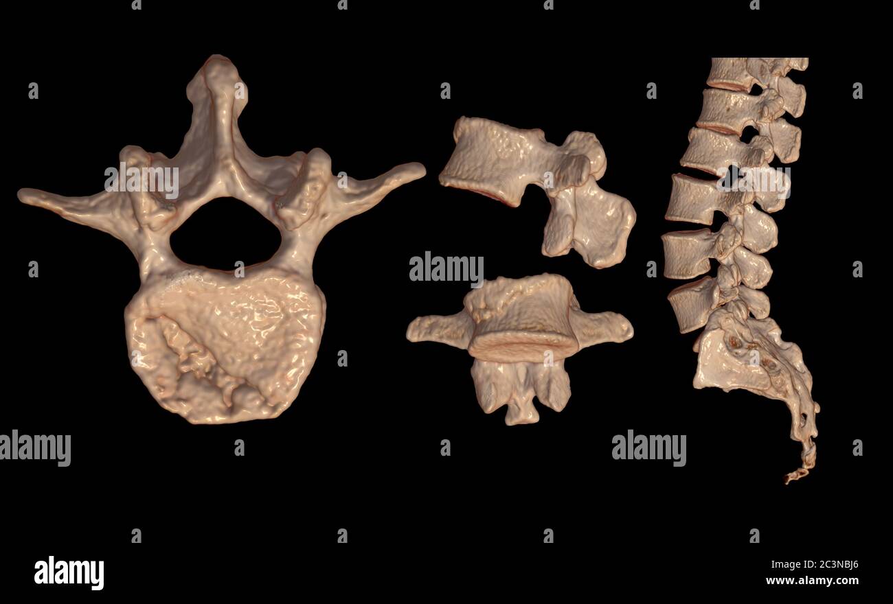 Ensemble d'images de rendu 3D CT lombaire ou rachis L-S montrant les ...