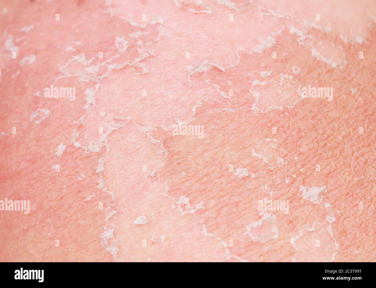 texture de la peau irritée roulée avec écailles de cellules mortes ...