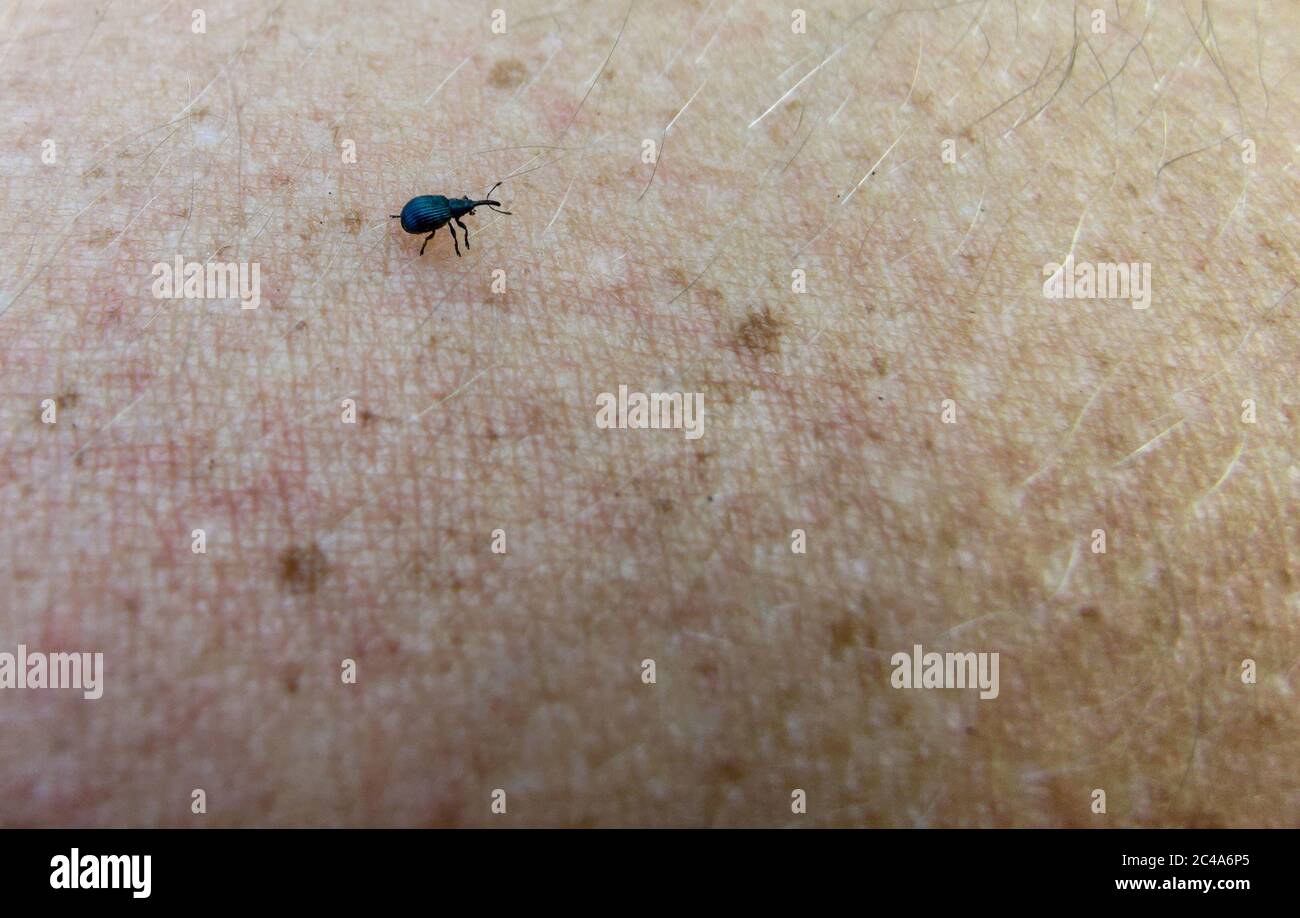 Insect bite skin Banque de photographies et d’images à haute résolution ...