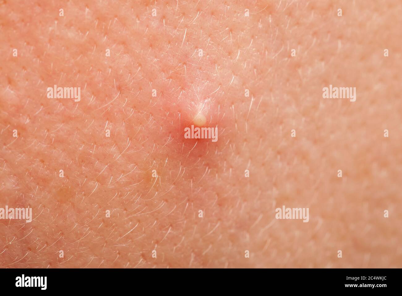 Tache Rouge Peau Sur Cicatrice Banque d'image et photos - Alamy