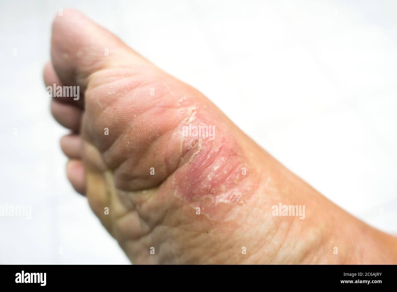 Infection De La Peau Banque d'image et photos - Alamy