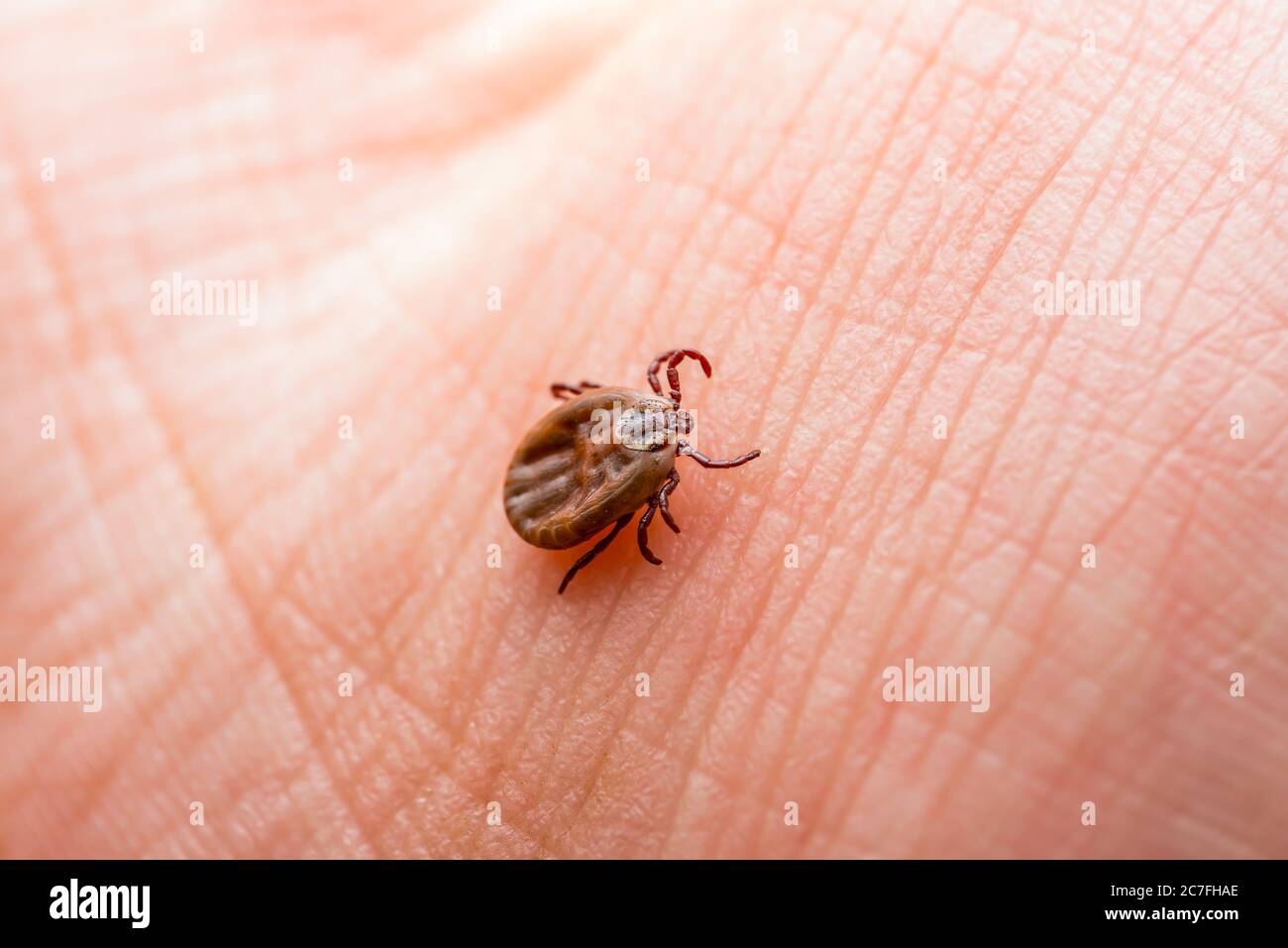 La maladie de Lyme tique infectée Insect rampant sur la peau. Virus de ...