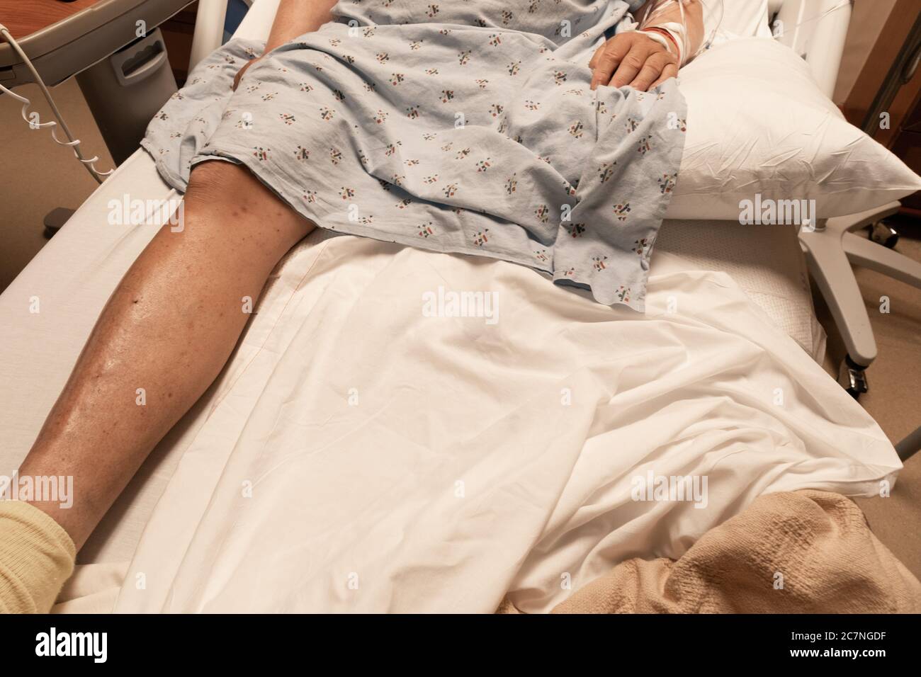 Lower limb amputation Banque de photographies et d’images à haute ...