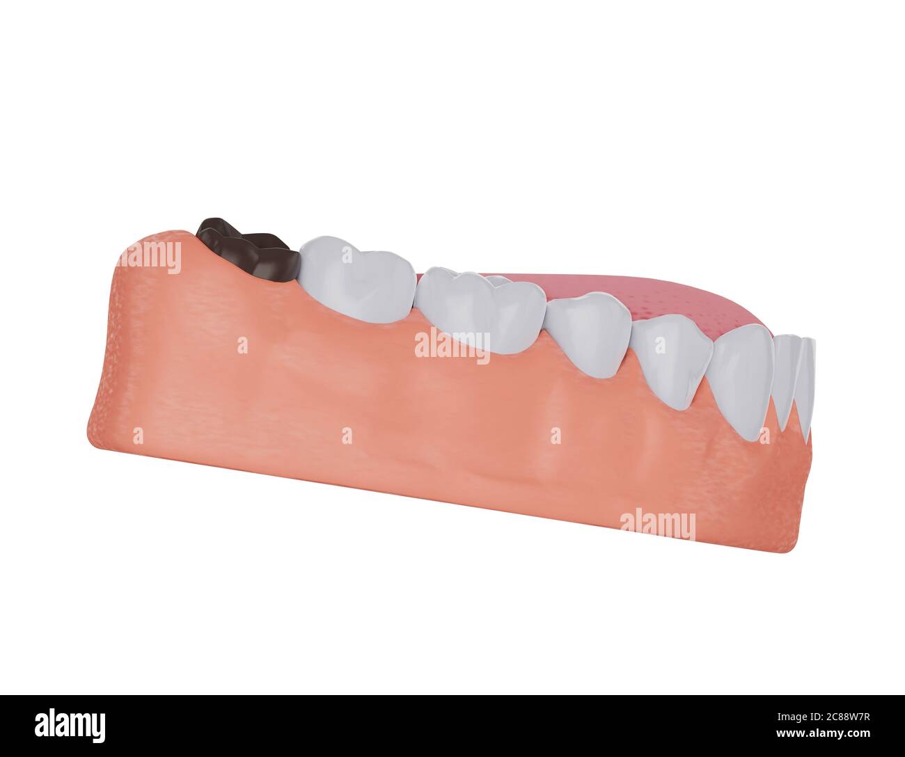 Caries bad teeth Banque d'images détourées - Alamy