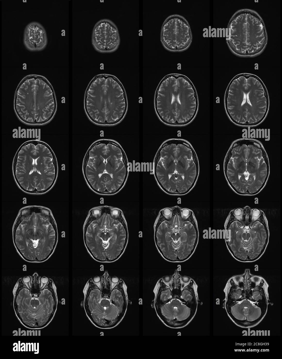 MRT scan, tête, femme avec sclérose en plaques Photo Stock - Alamy