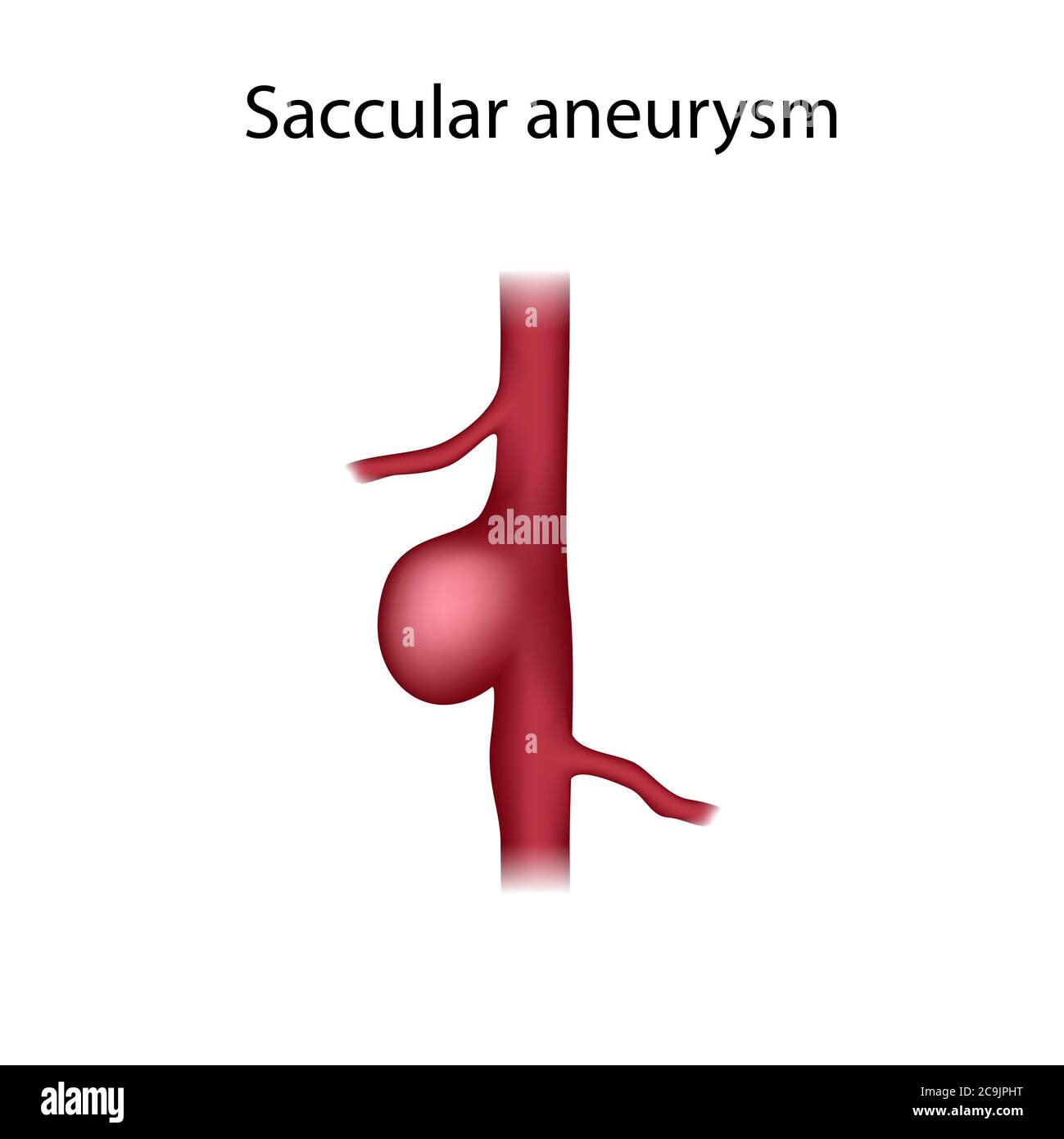 Anévrisme sacculaire Banque de photographies et d’images à haute ...