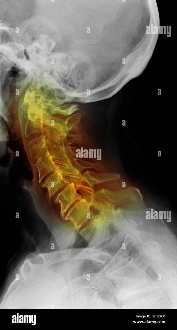 Arthrose de la colonne cervicale. Radiographie latérale colorée du cou ...