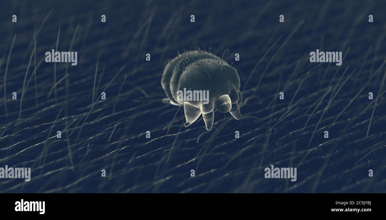 Acarien de la gale sur la peau humaine, illustration informatique Photo ...