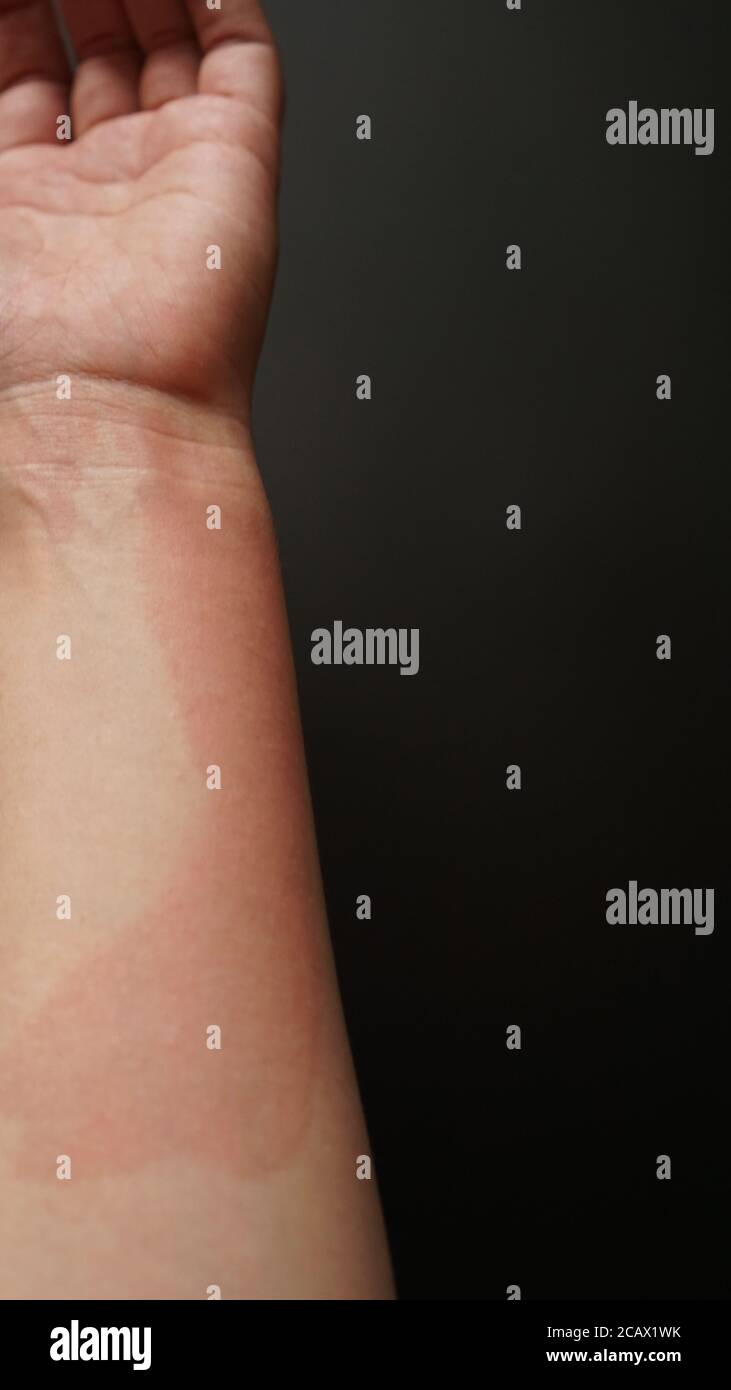 Tache rouge peau psoriasis Banque de photographies et d’images à haute ...