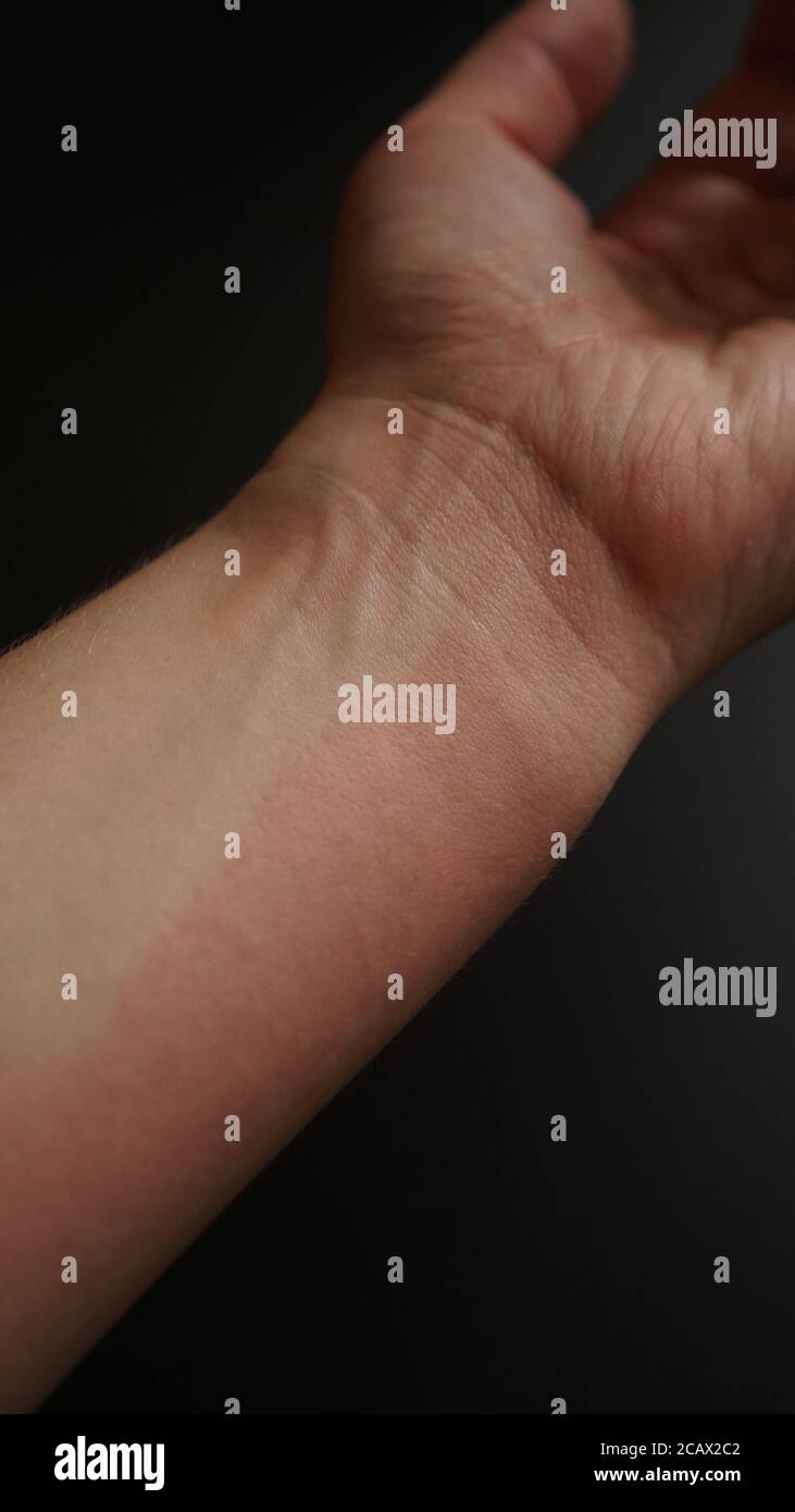 Tache rouge peau sur la jambe Banque de photographies et d’images à ...