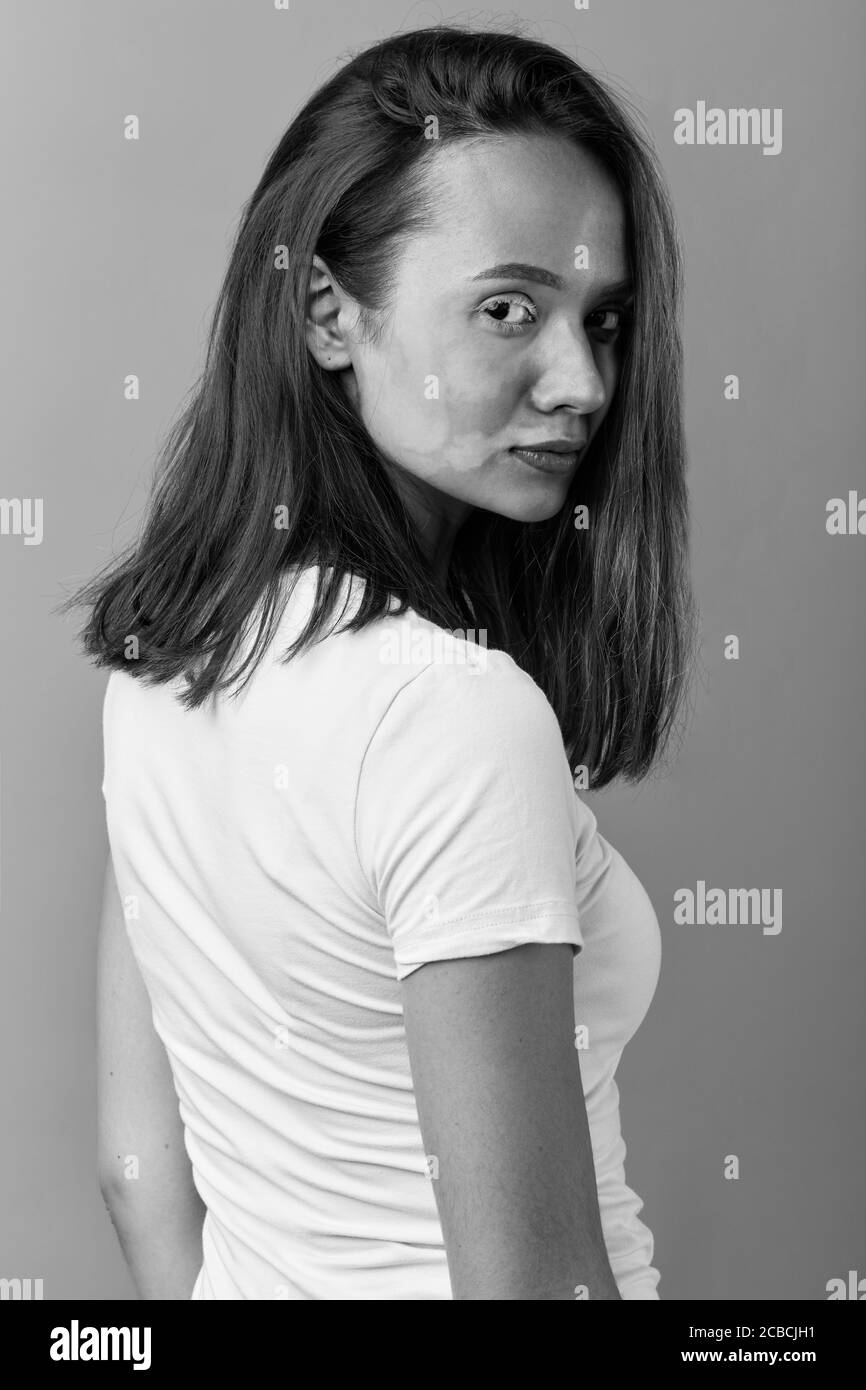 Taches brunes peau humaine Banque de photographies et d’images à haute ...