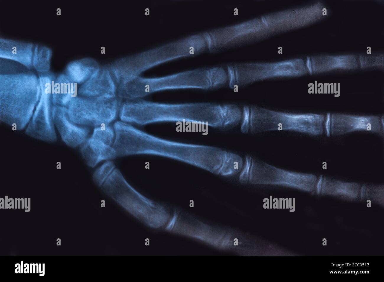 Image radiologique médicale de la main humaine. Diagnostic radiologique ...