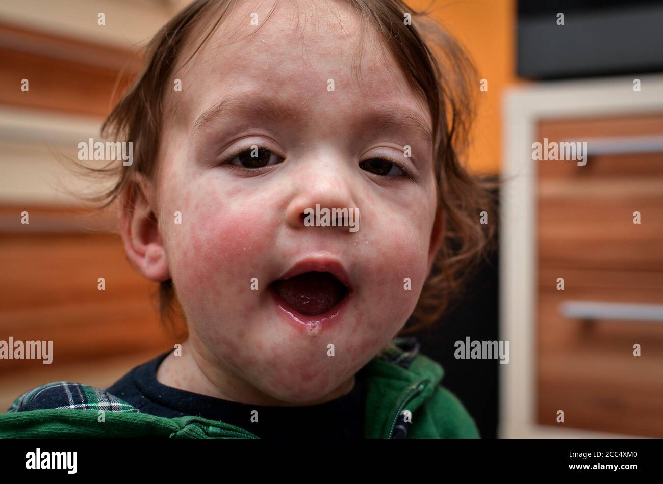 Maladies virales ou allergies chez les enfants. Éruption de rougeole ...