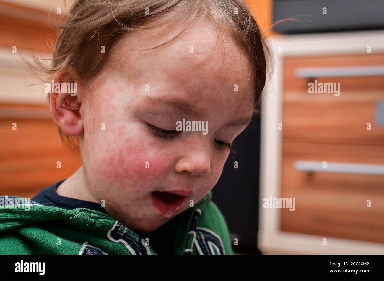 Maladies virales ou allergies chez les enfants. Éruption de rougeole ...