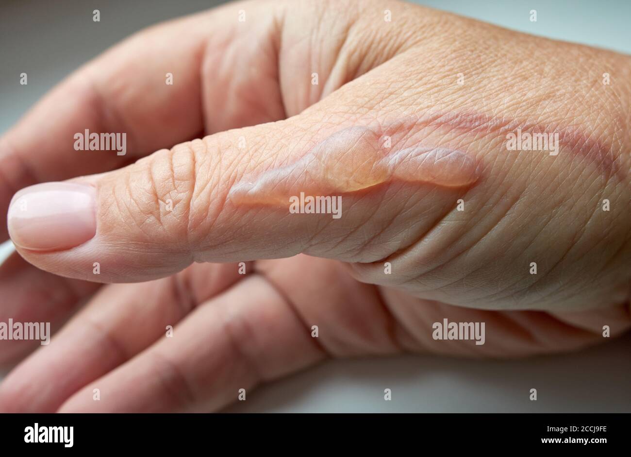 Rougeurs sur les mains Banque de photographies et d’images à haute ...