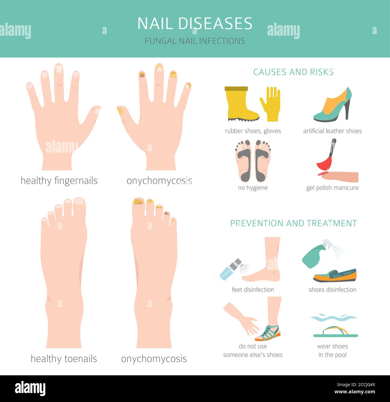 Maladies des ongles. Onychomycose, infections fongiques des ongles ...
