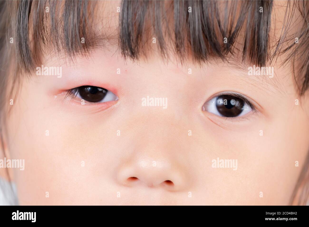 Inflammation of the eye Banque de photographies et d’images à haute ...