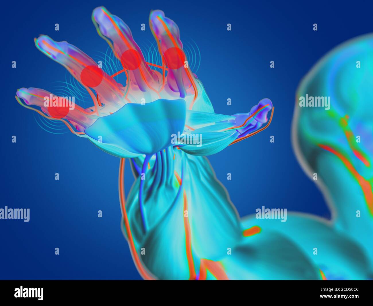 Arthrite dans les doigts ou la main. Illustration Anatomy 3D Photo ...