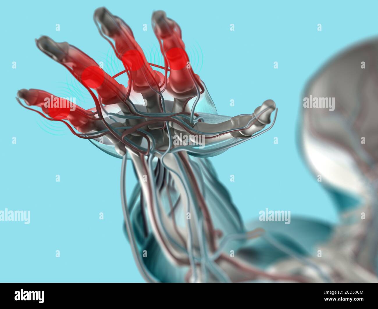 Arthrite dans les doigts ou la main. Illustration Anatomy 3D Photo ...