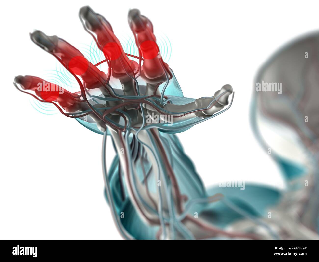 Arthrite dans les doigts ou la main. Illustration Anatomy 3D Photo ...