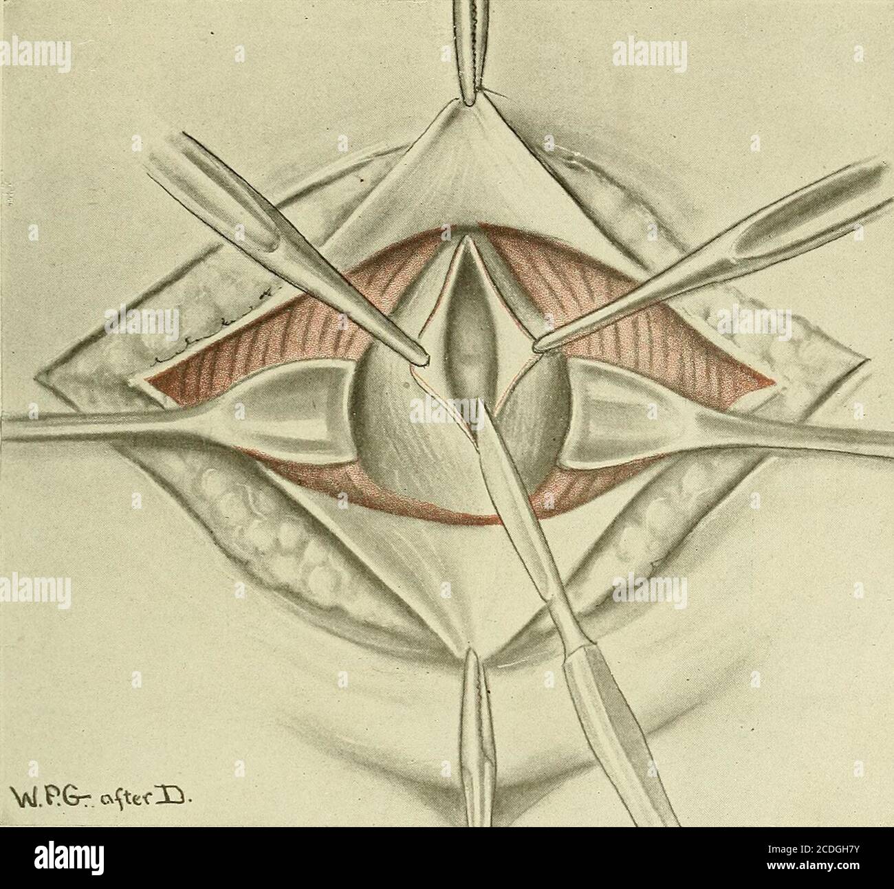 Incision de pfannenstiel Banque de photographies et d’images à haute ...