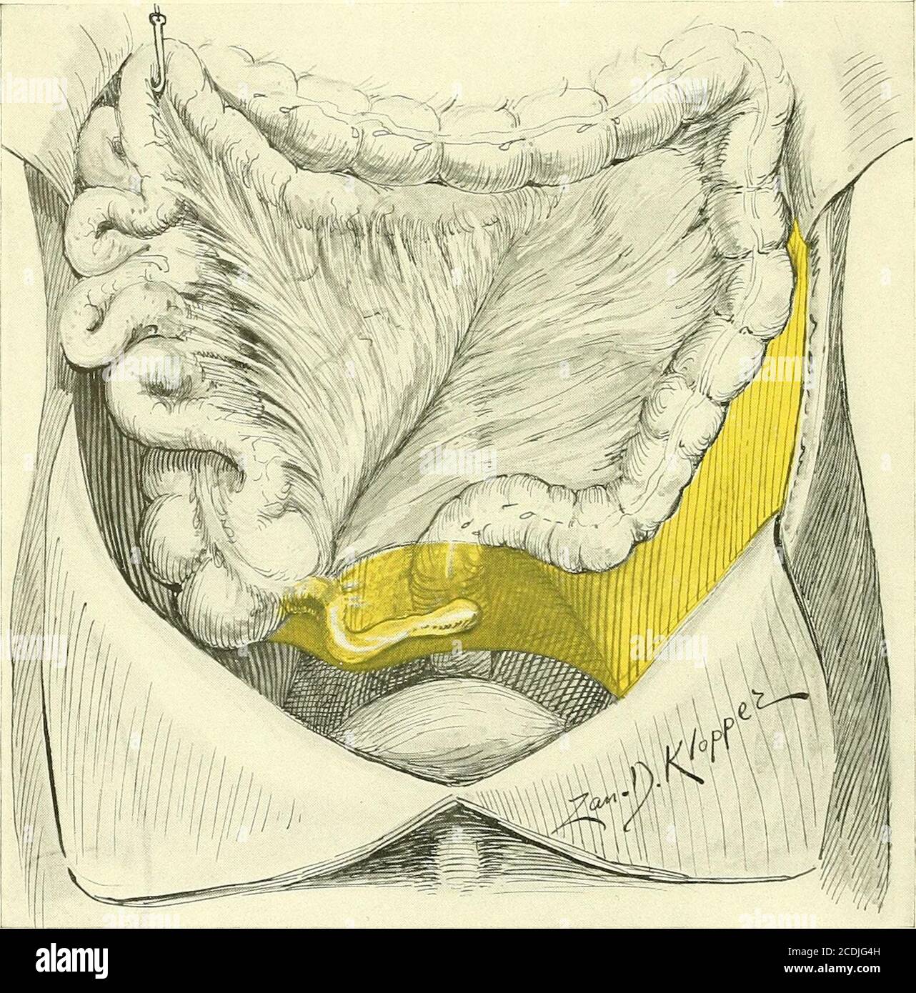 Appendix vermiformis Banque de photographies et d’images à haute ...