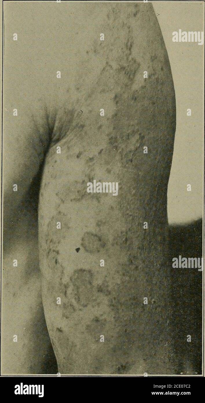 érythème polymorphe Banque de photographies et d’images à haute ...