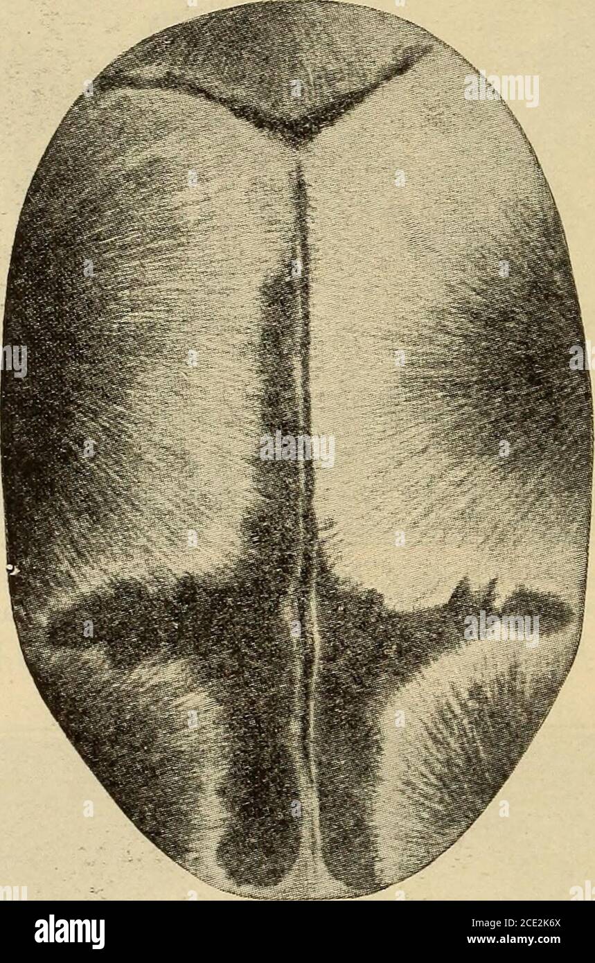 Cas De Spina Bifida Banque d'image et photos - Alamy