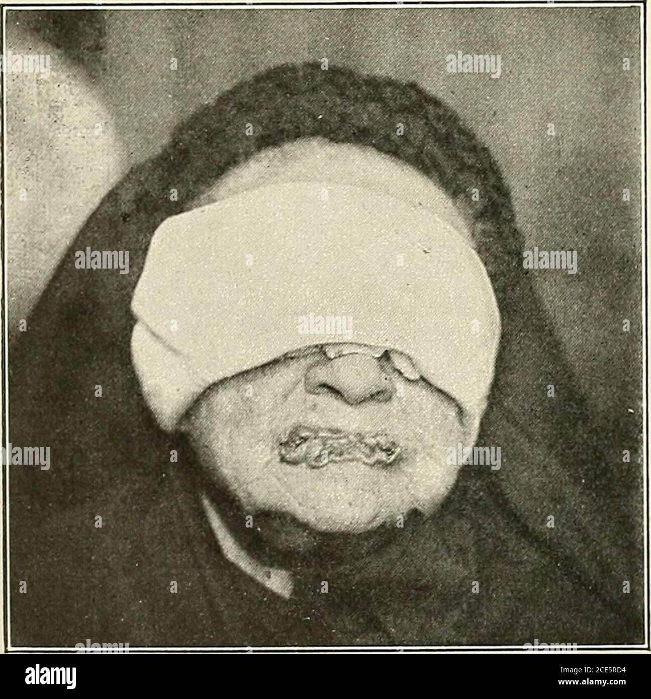 Cancer de la langue chirurgie Banque de photographies et d’images à ...