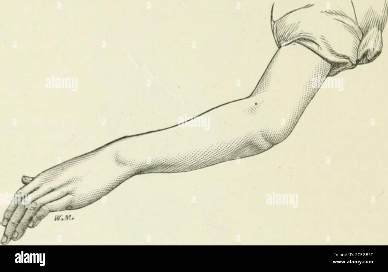 Hémorragie bras Banque de photographies et d’images à haute résolution ...