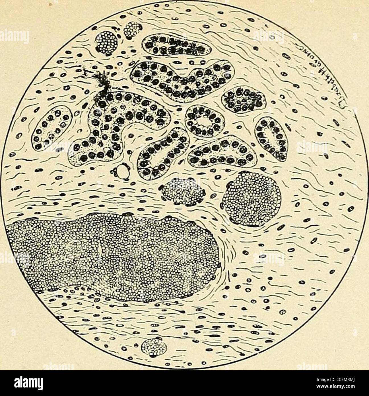 . Maladies des enfants. Figure 54.—rein kystique congénital chez un ...