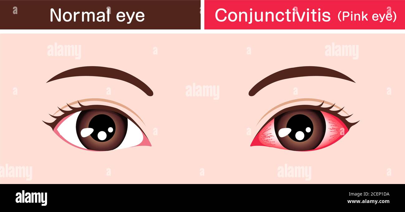 Conjonctivite oculaire Banque d'images vectorielles - Alamy