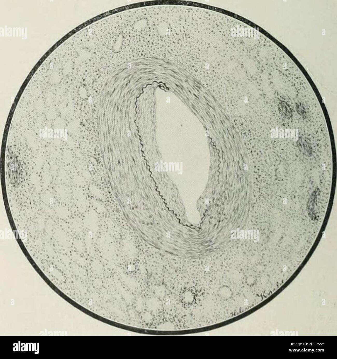 Neurofibrome plexiforme Banque de photographies et d’images à haute ...