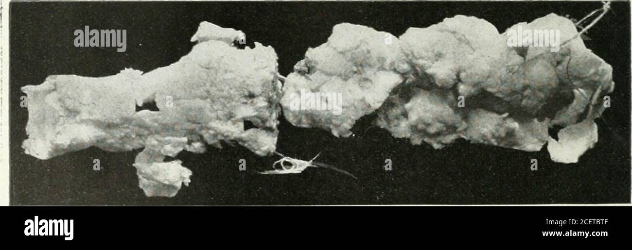 Fracture pathologique Banque de photographies et d’images à haute ...