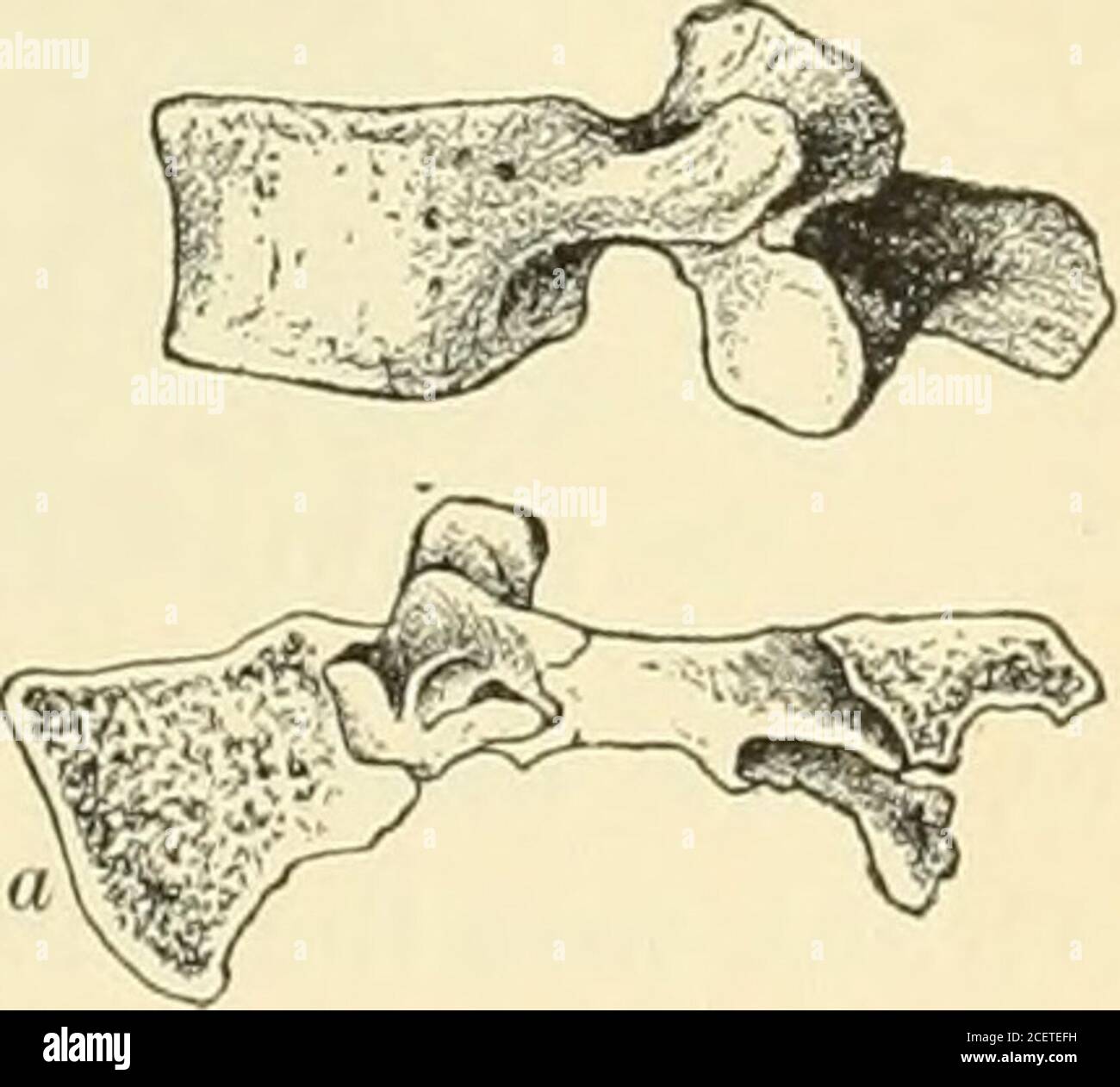 Lumbar spondylolisthesis Banque de photographies et d’images à haute ...