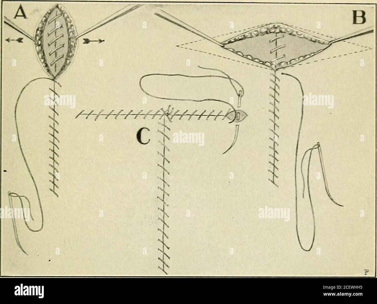 Transverse muscle abdominaux Banque de photographies et d’images à ...