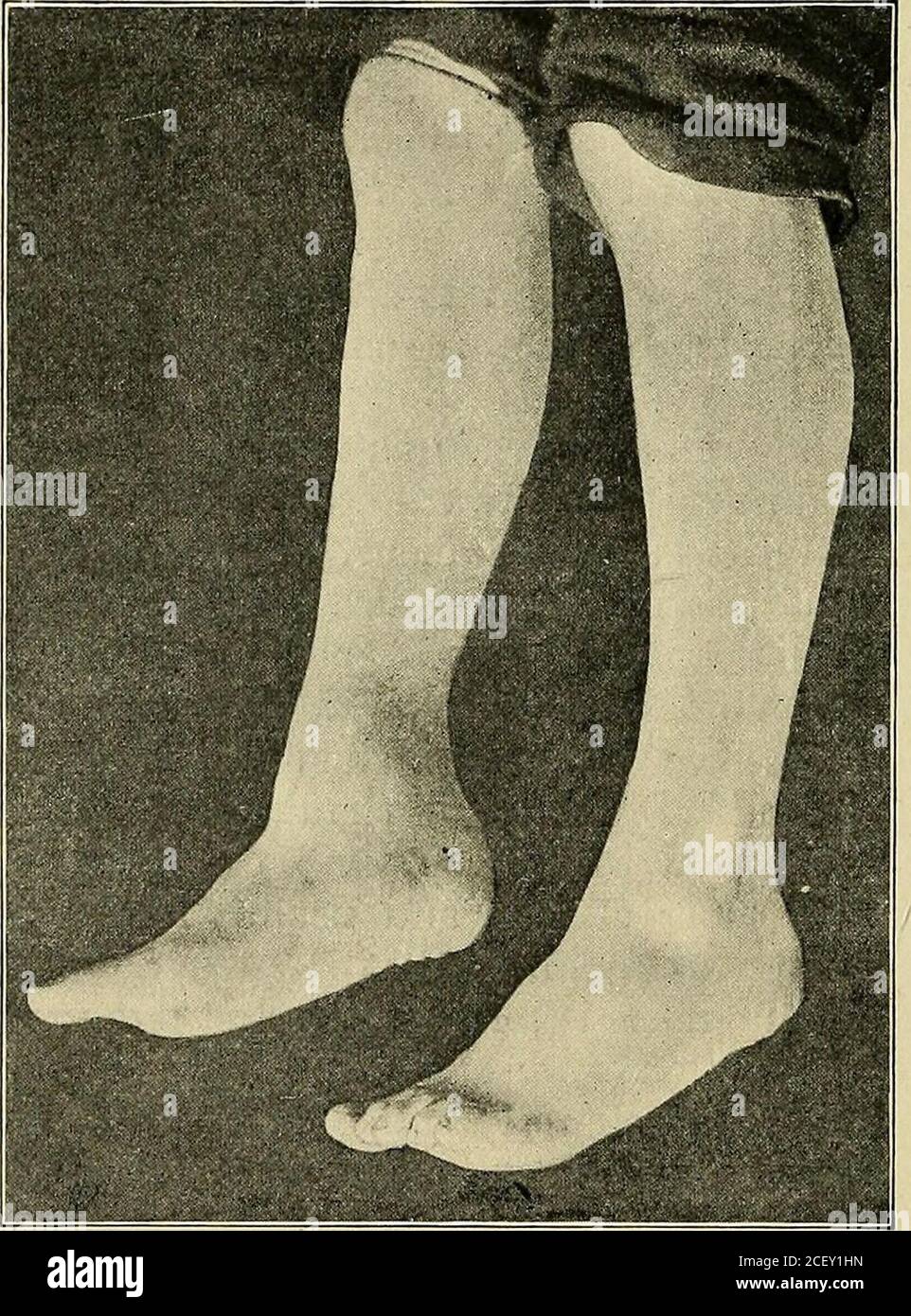 Tibial fracture Banque de photographies et d’images à haute résolution ...