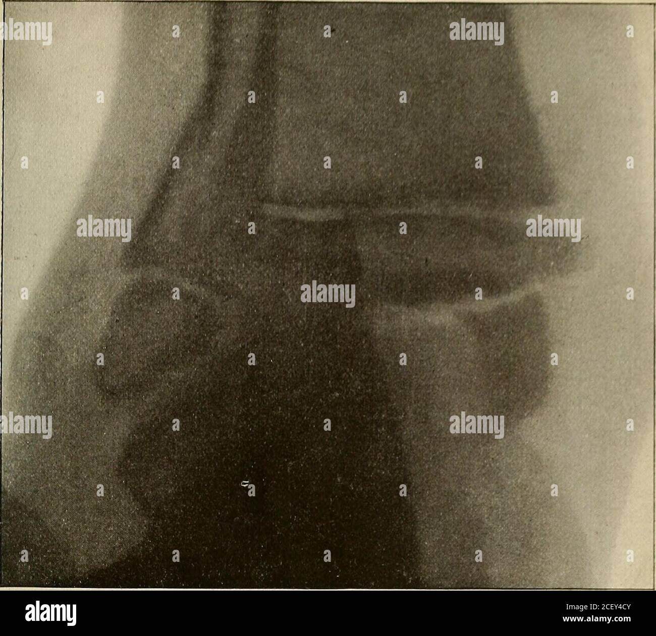 . Un traité pratique sur les fractures et les dislocations. Fracture de ...