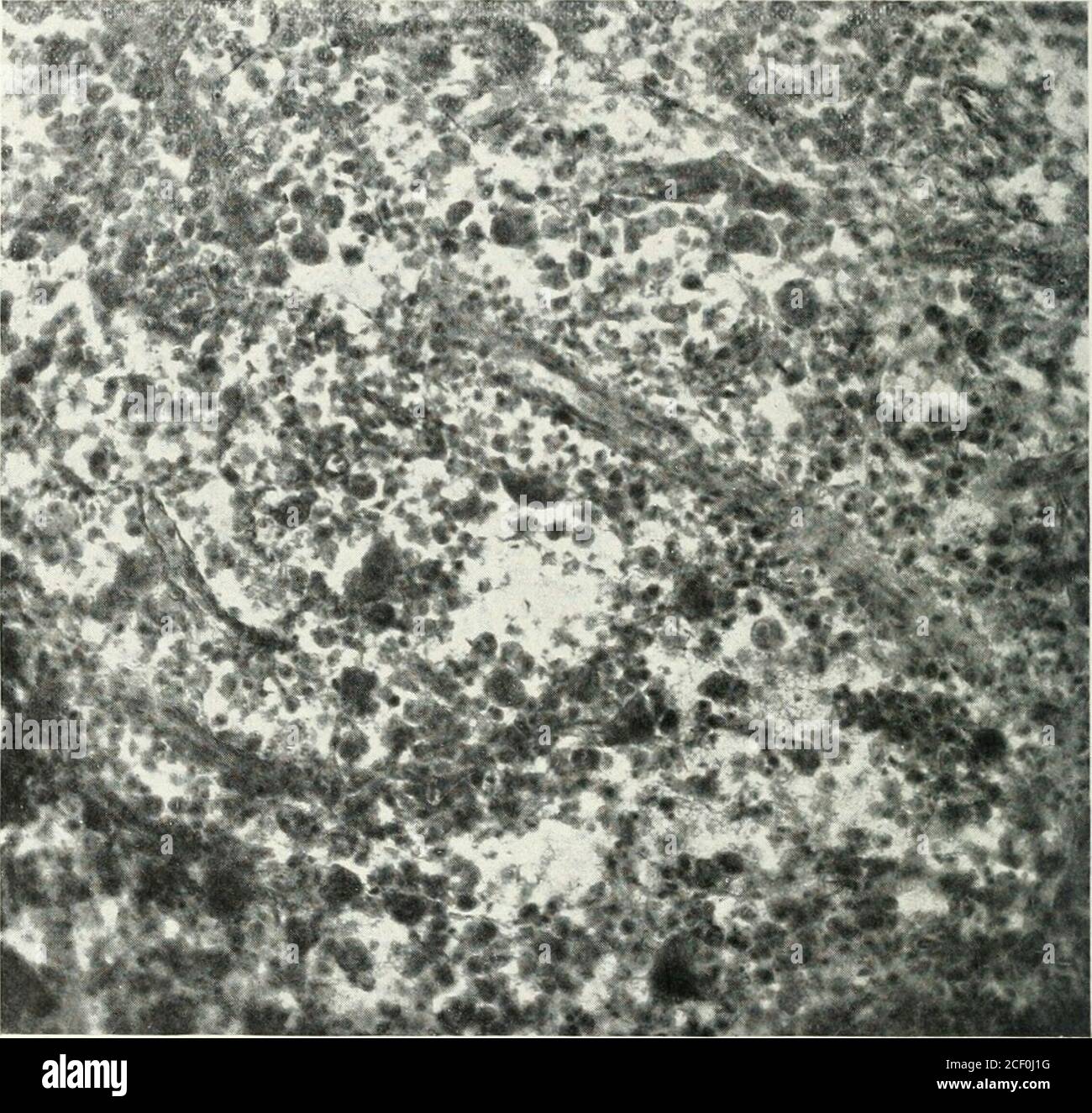 . Annales de chirurgie. Cas 111. Myélome à cellules rondes et ...