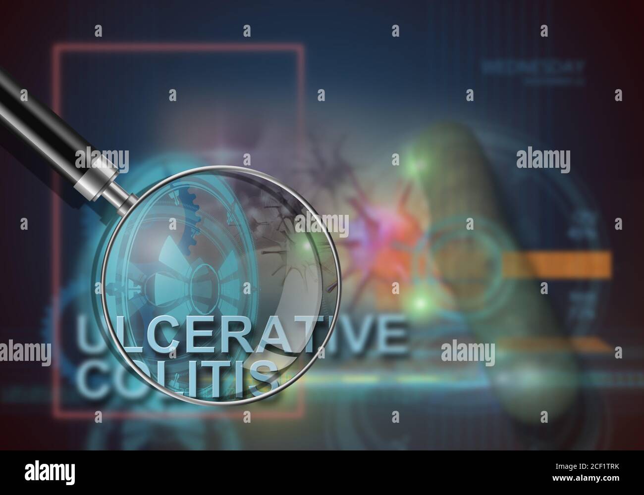 Rectocolite hemorragique Banque de photographies et d’images à haute ...