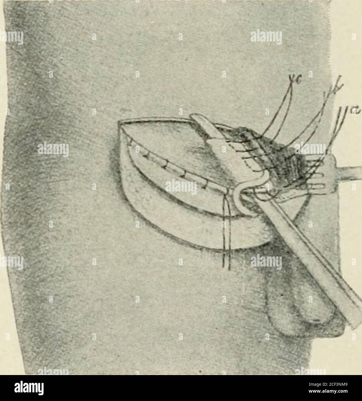 Hernie inguinale directe Banque de photographies et d’images à haute ...