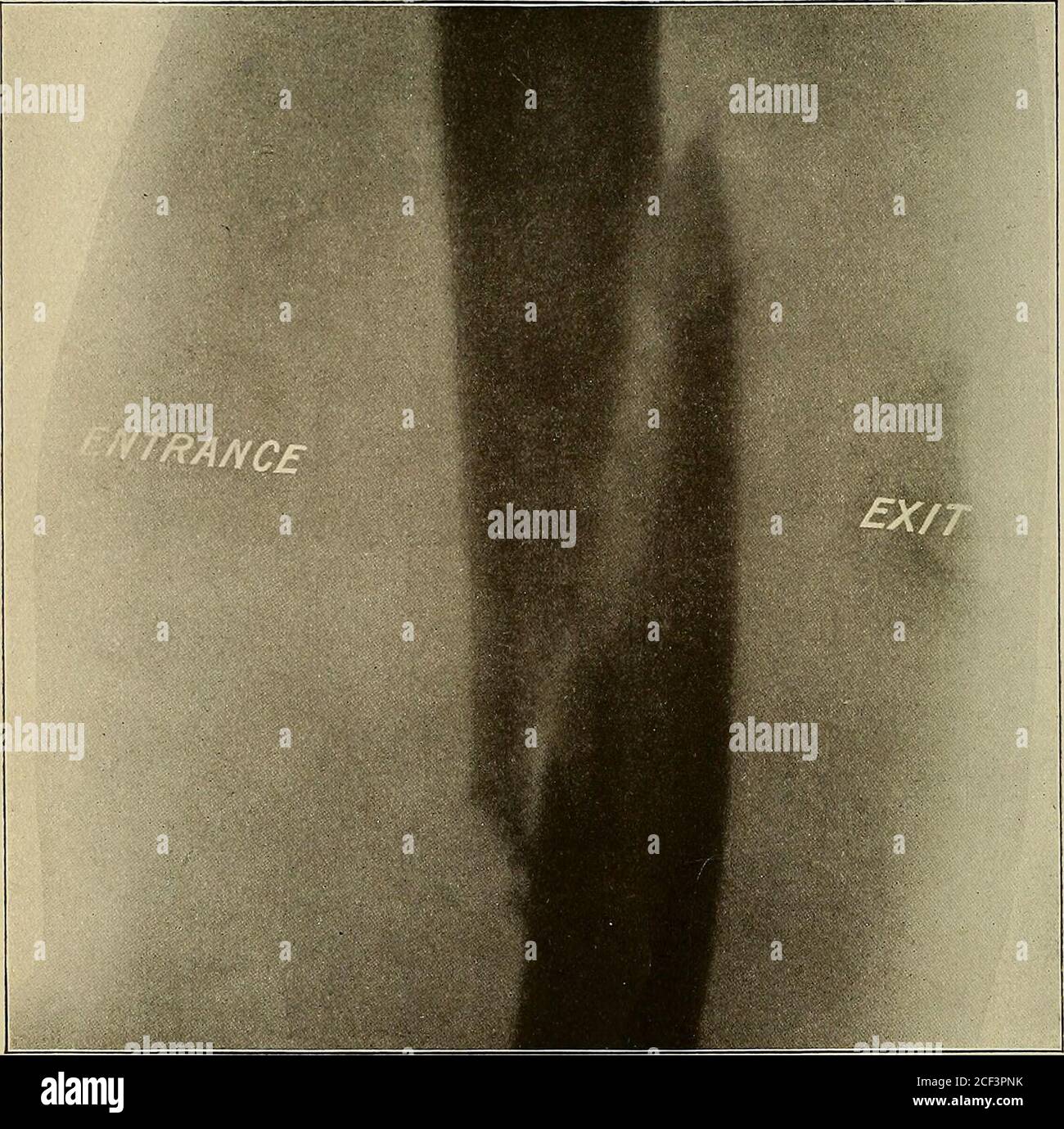 . Un traité pratique sur les fractures et les dislocations. Figure 2 ...