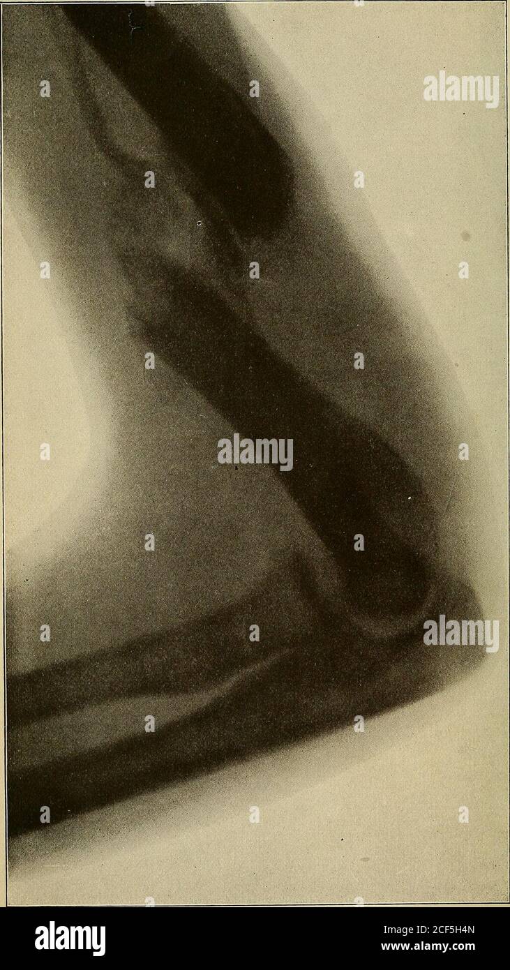 Fractures des plaques de croissance Banque de photographies et d’images ...