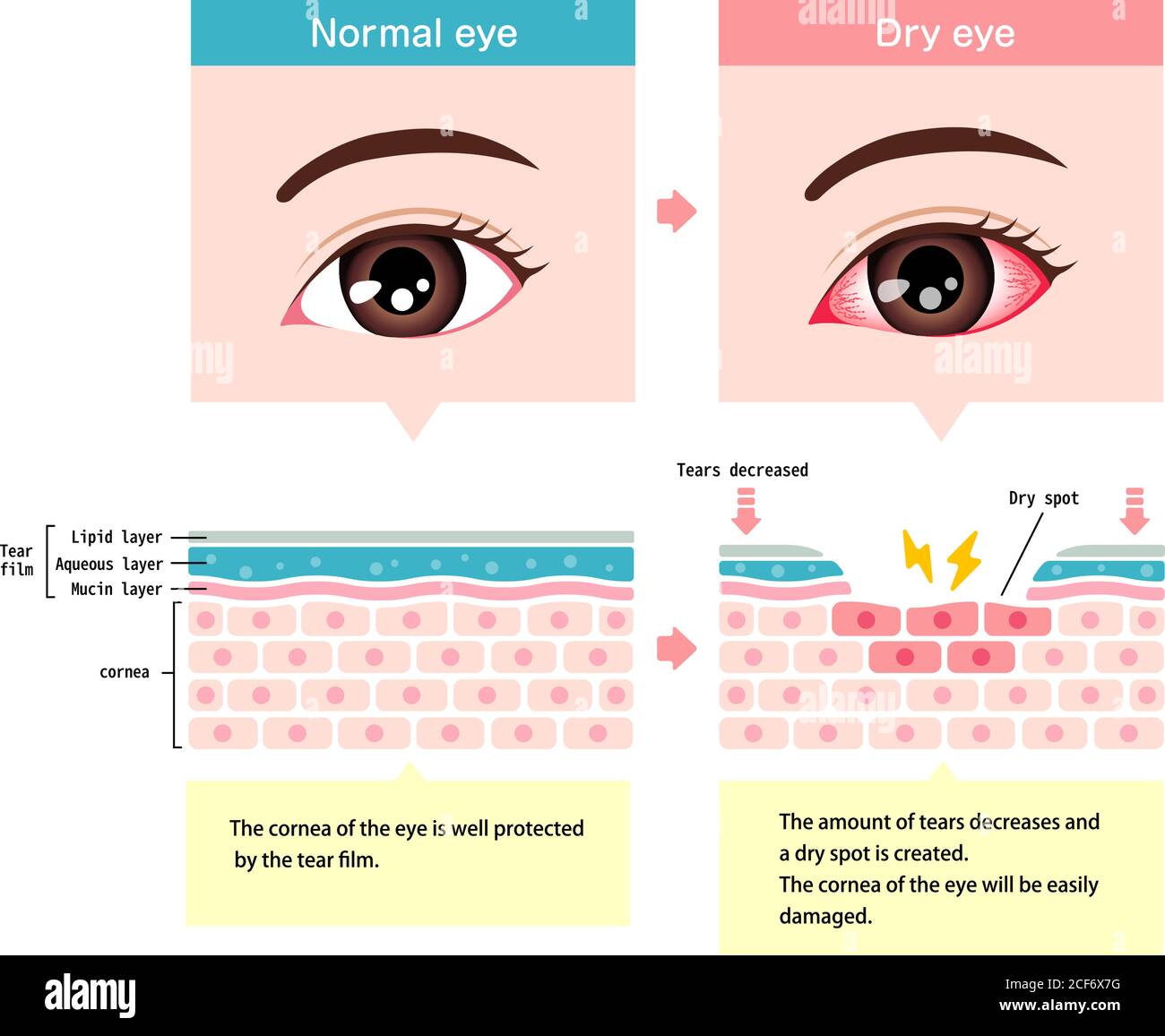 Illustration de comparaison entre l'œil normal et l'œil sec. Coupe ...