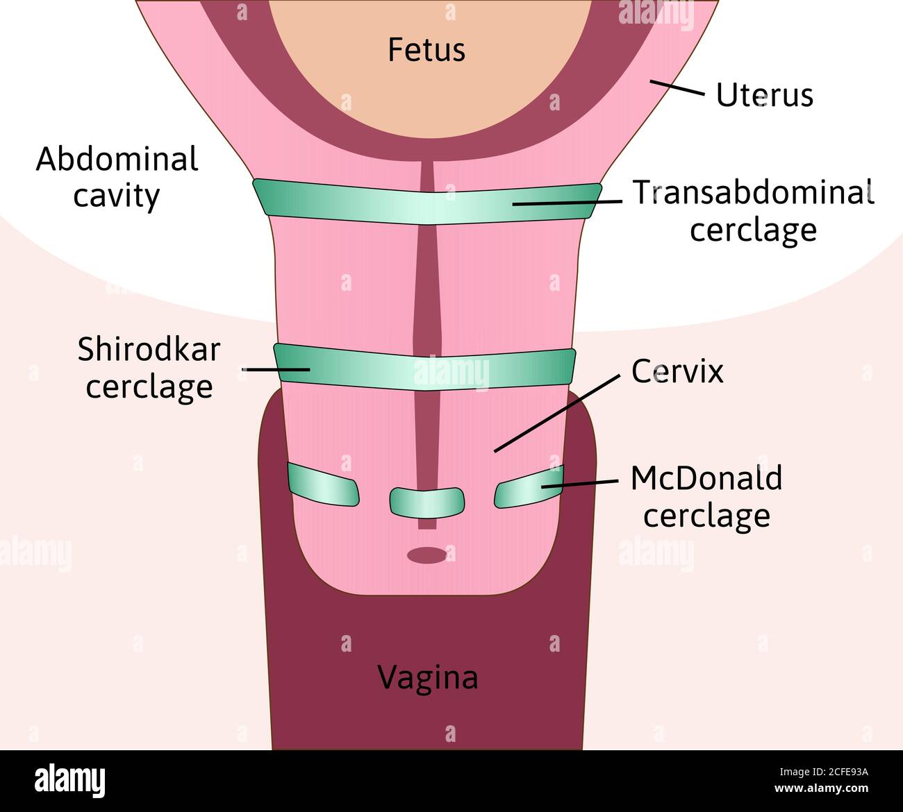 Trois types de cerclage cervical ou point cervical, traitement pour la ...