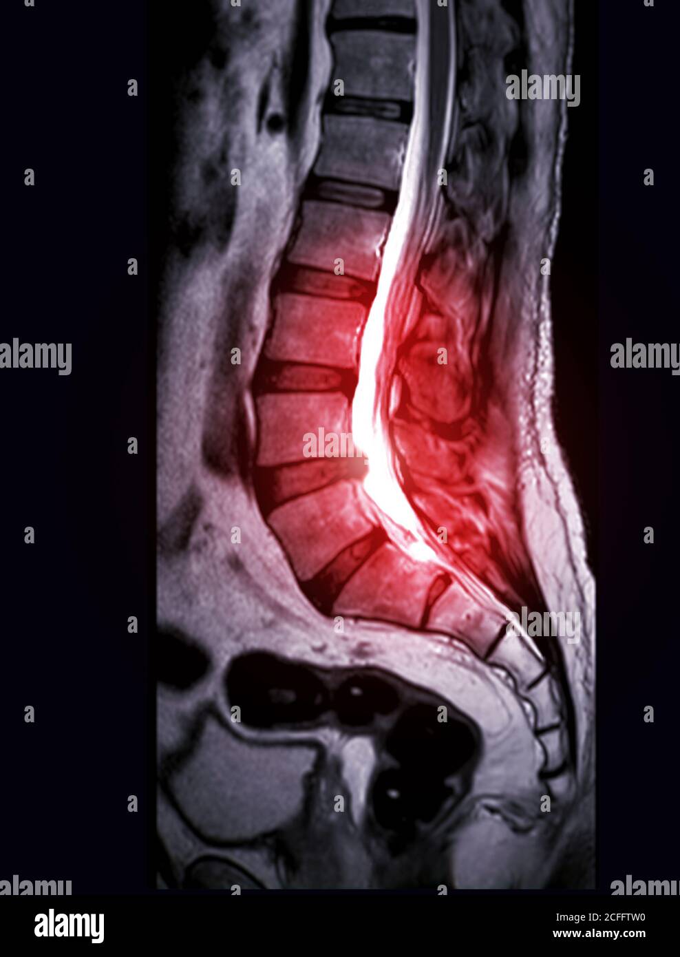 Hernie discale irm Banque de photographies et d’images à haute résolution - Alamy