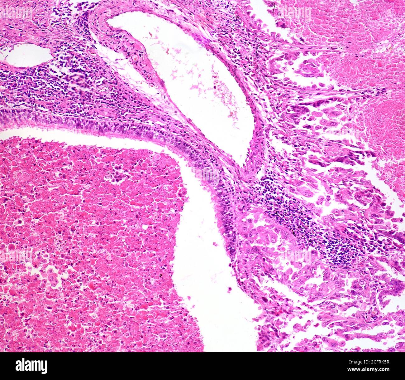 Biopsie pulmonaire Banque de photographies et d’images à haute ...