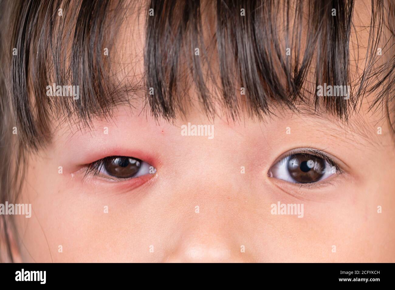 Inflammation des paupières Banque de photographies et d’images à haute ...