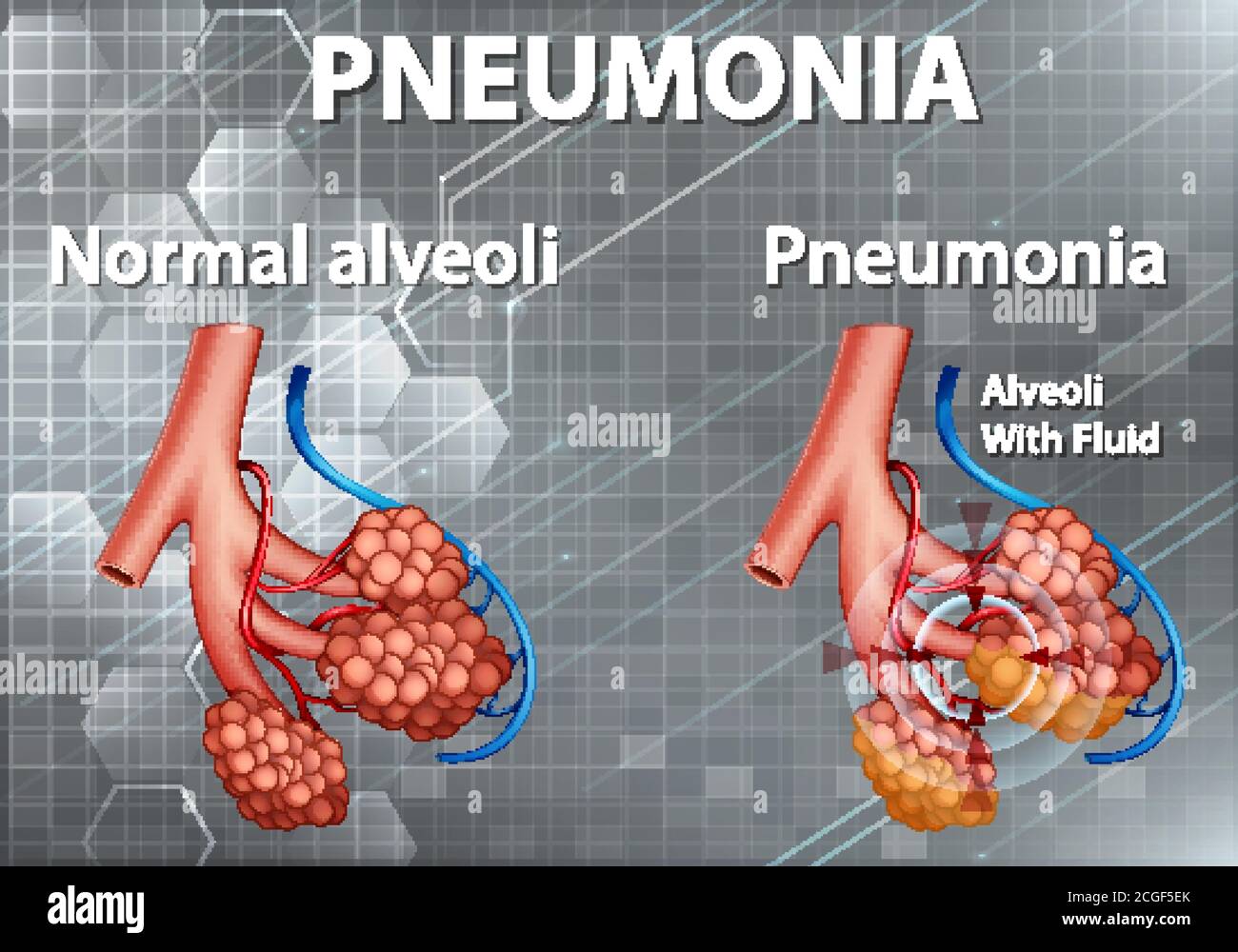 Anatomie humaine montrant une illustration de la pneumonie Image ...