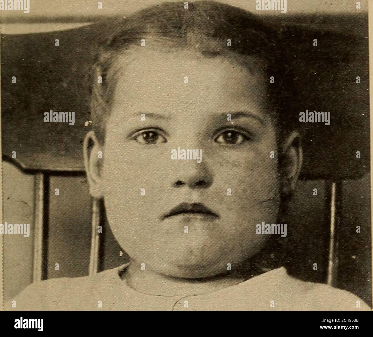 Parotidite des oreillons Banque de photographies et d’images à haute ...